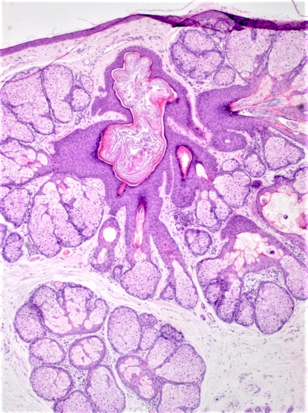 Pathology Outlines - Sebaceous hyperplasia