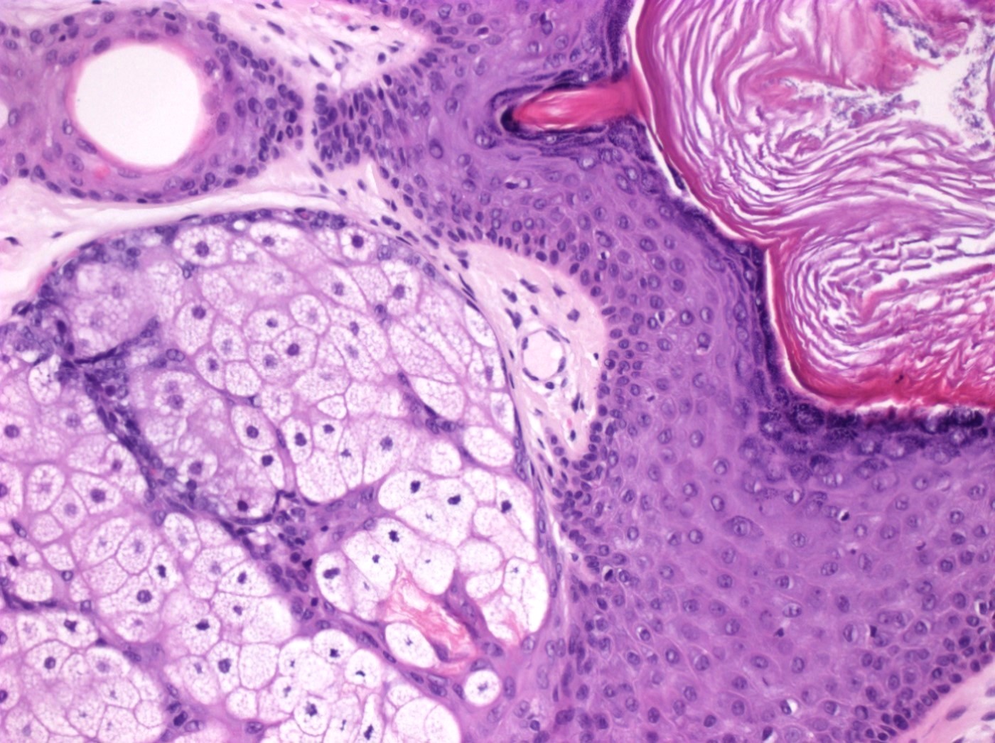 Pathology Outlines - Sebaceous hyperplasia