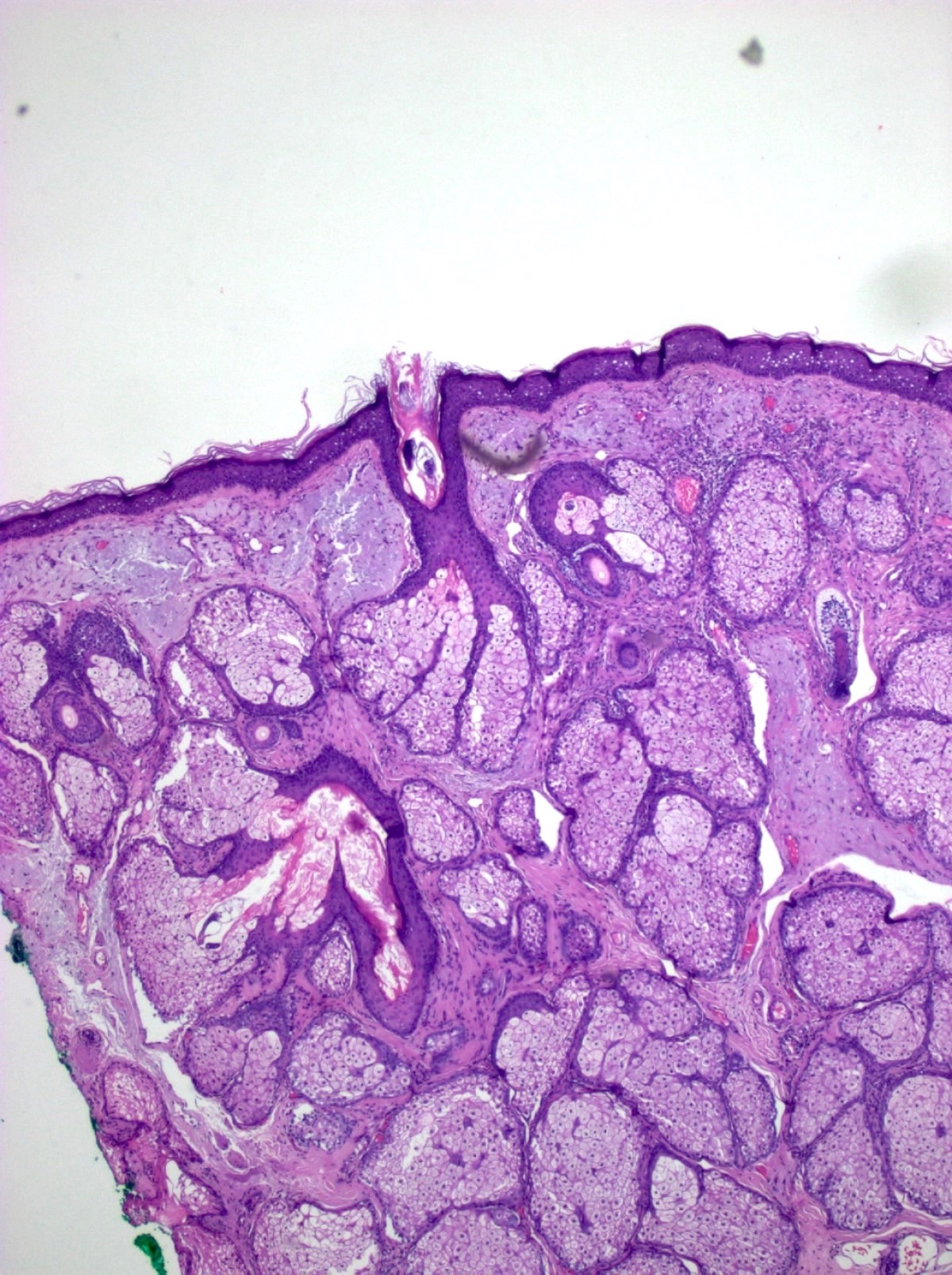 Pathology Outlines - Sebaceous hyperplasia