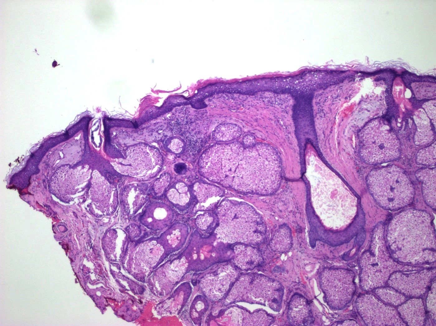 Pathology Outlines - Sebaceous hyperplasia