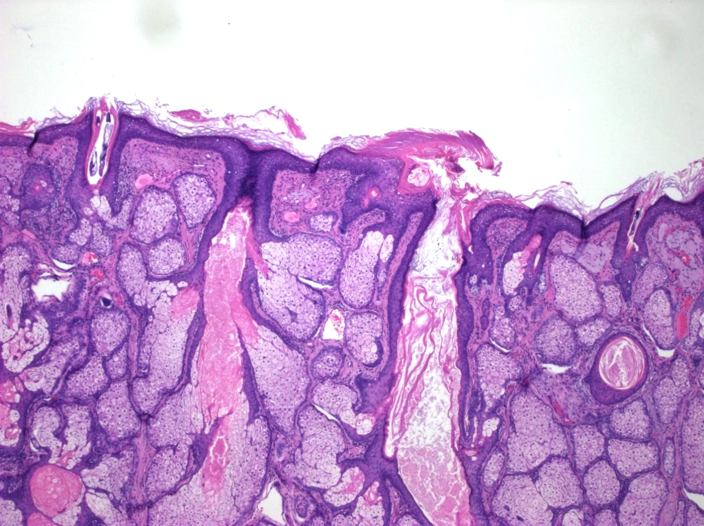 Pathology Outlines - Sebaceous hyperplasia