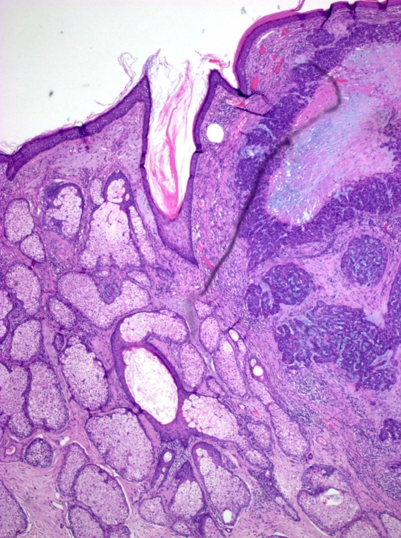 Pathology Outlines - Sebaceous hyperplasia