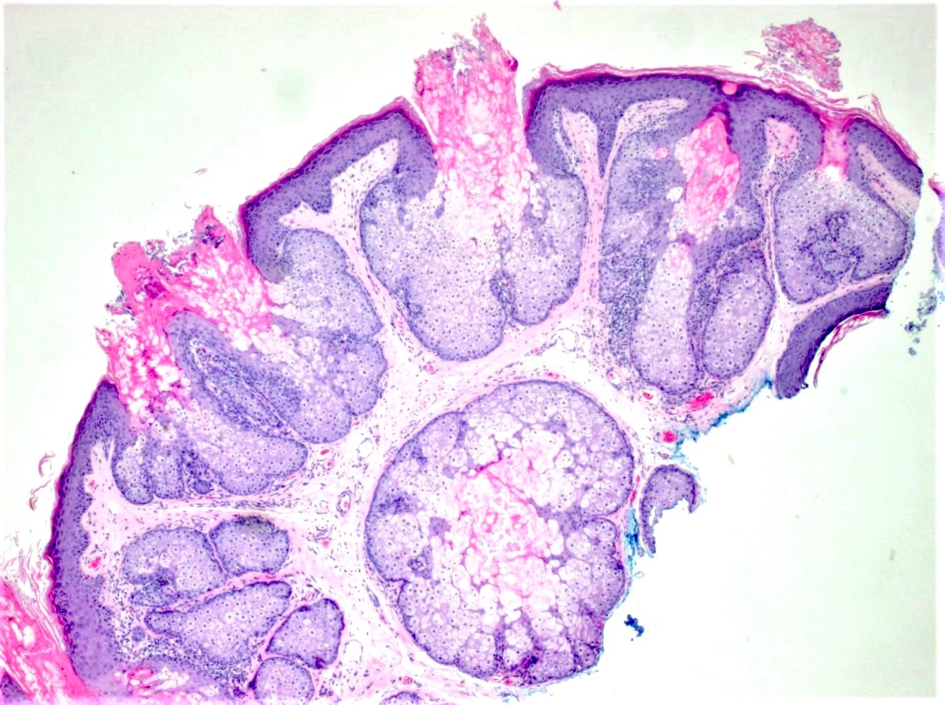 Pathology Outlines - Sebaceous hyperplasia