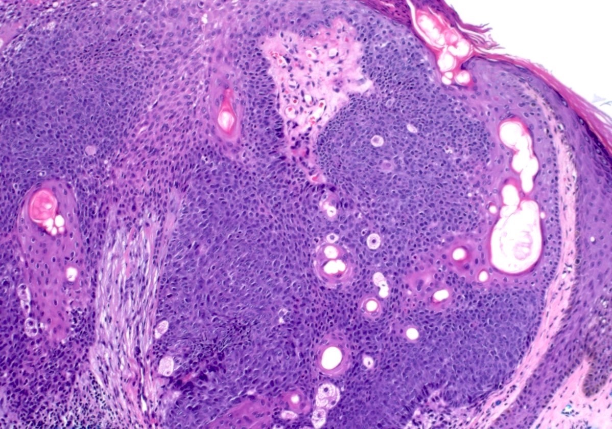 Pathology Outlines - Sebaceous hyperplasia