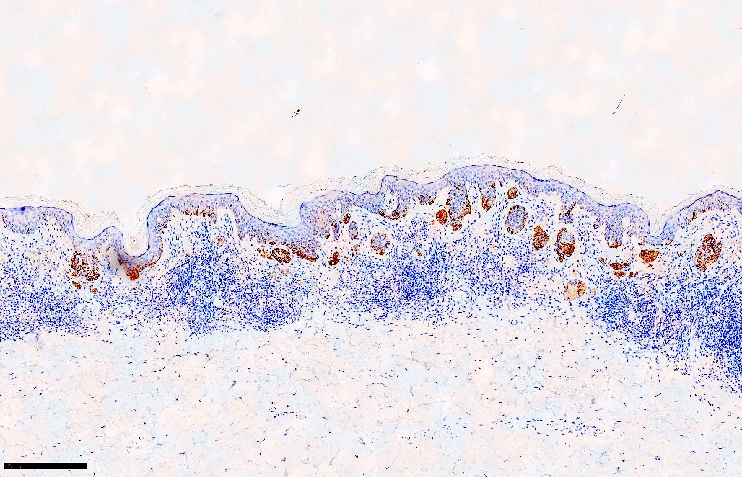Pathology Outlines - Halo nevus