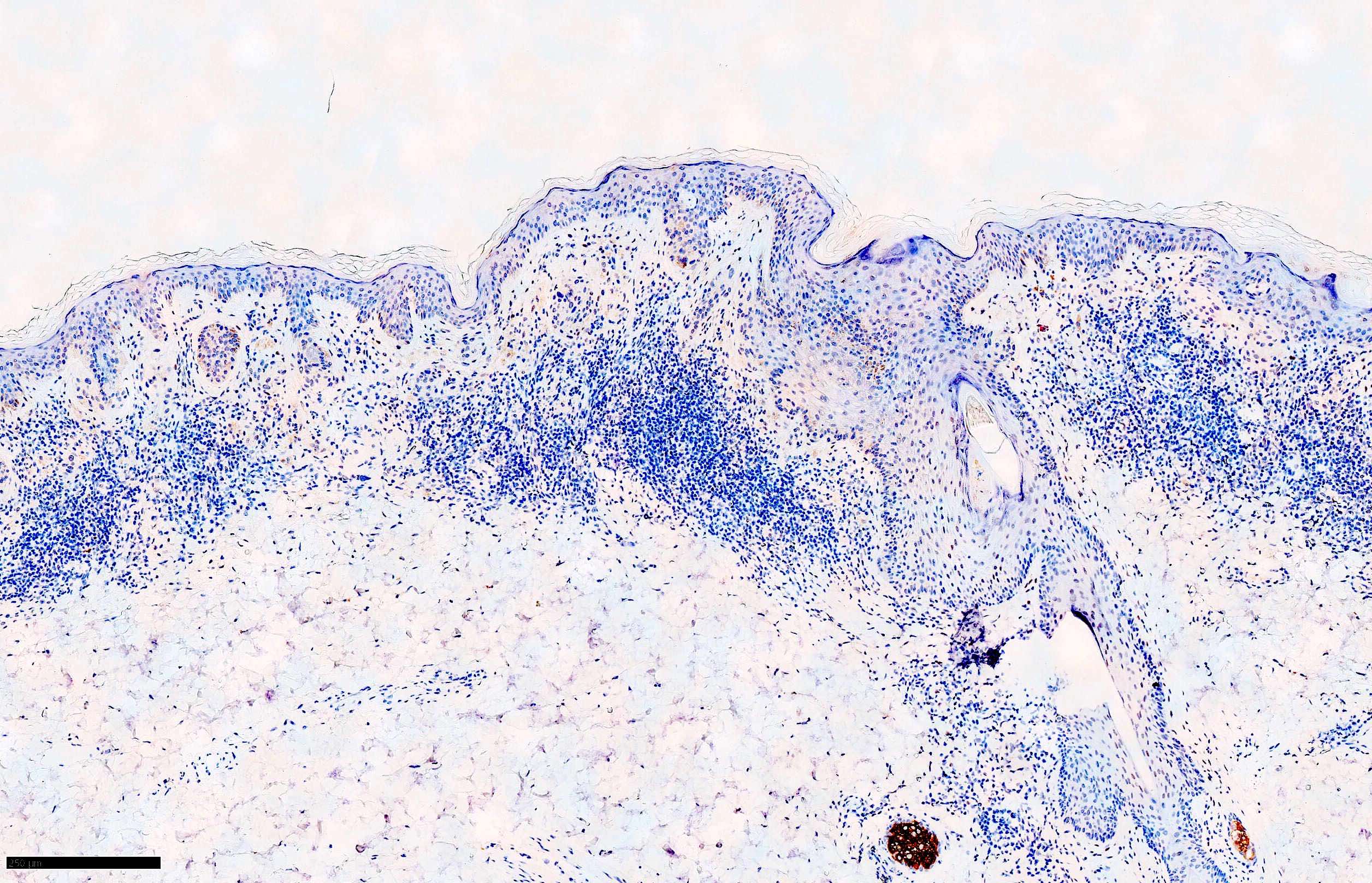 Pathology Outlines - Halo nevus