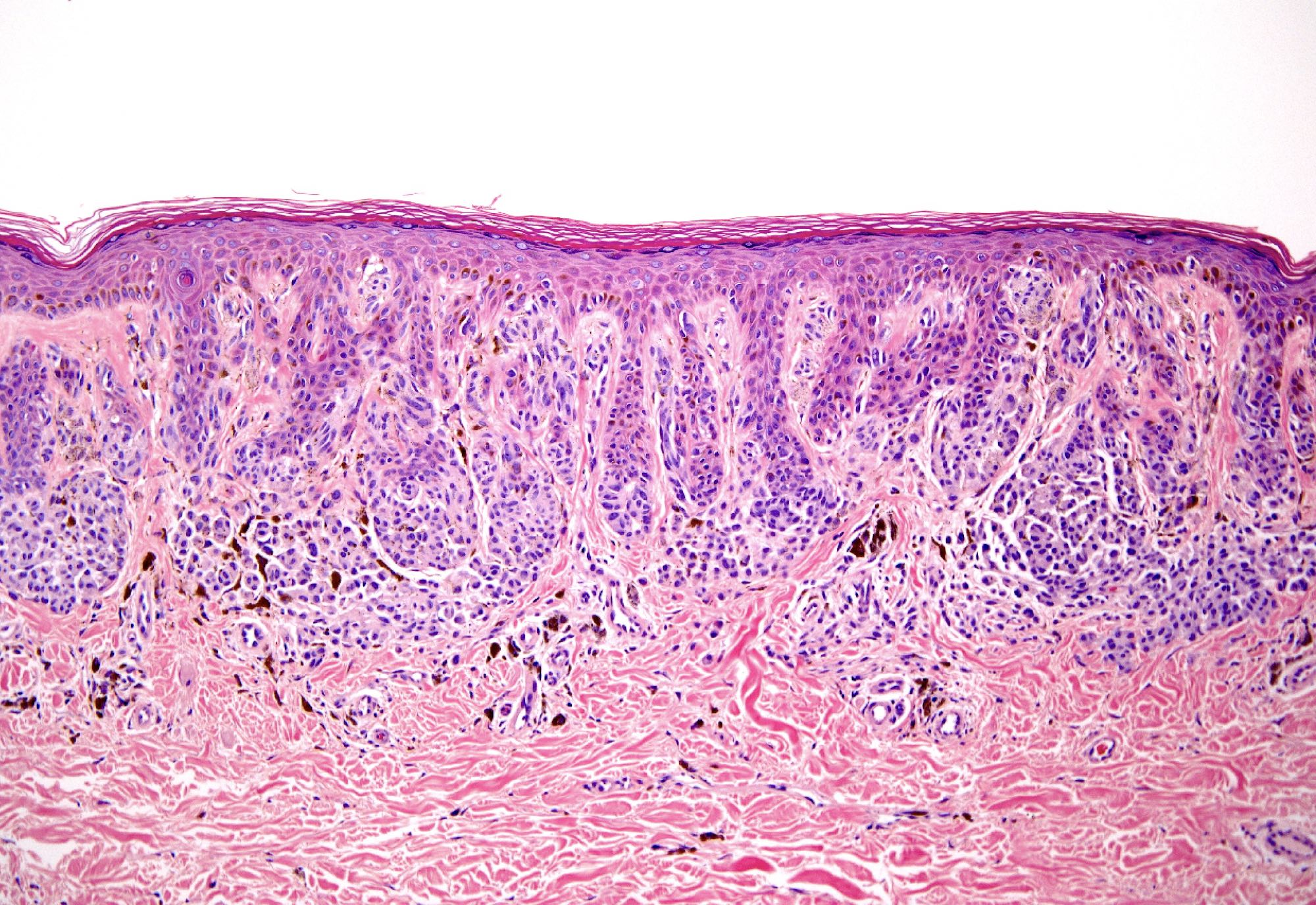 Pathology Outlines - WHO classification for pediatric melanocytic neoplasms