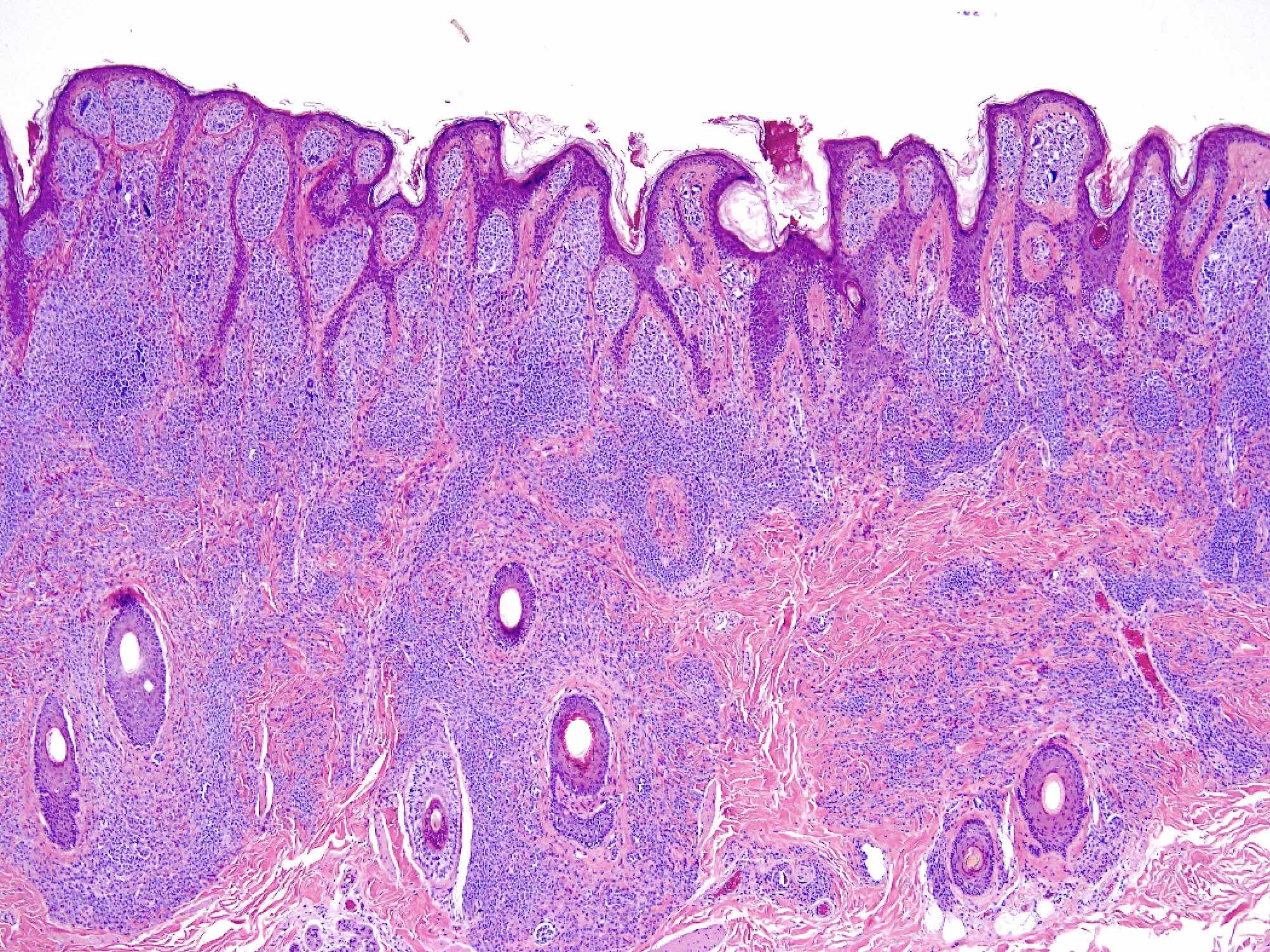 Pathology Outlines - WHO classification for pediatric melanocytic neoplasms