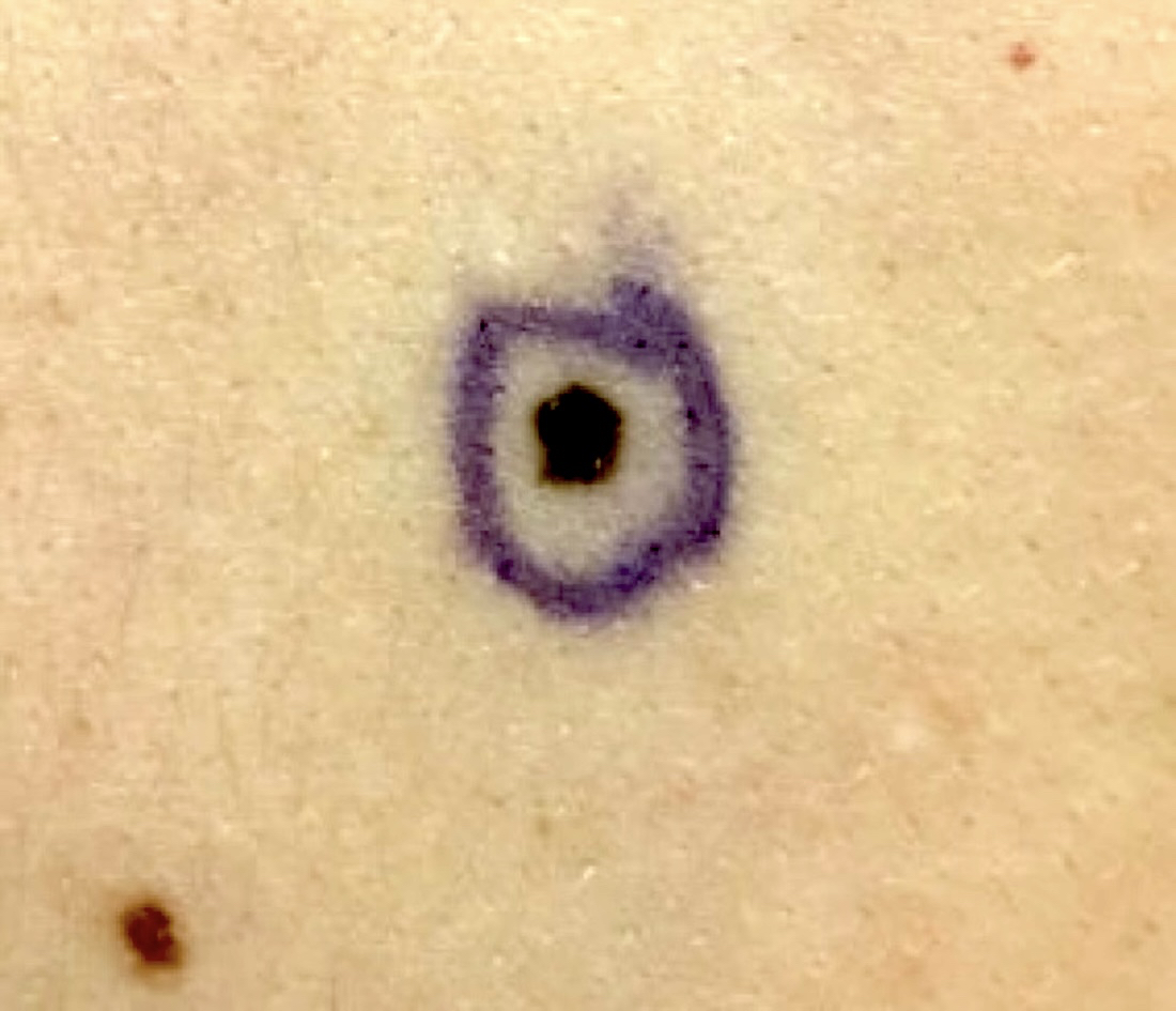 Pathology Outlines - Reed nevus