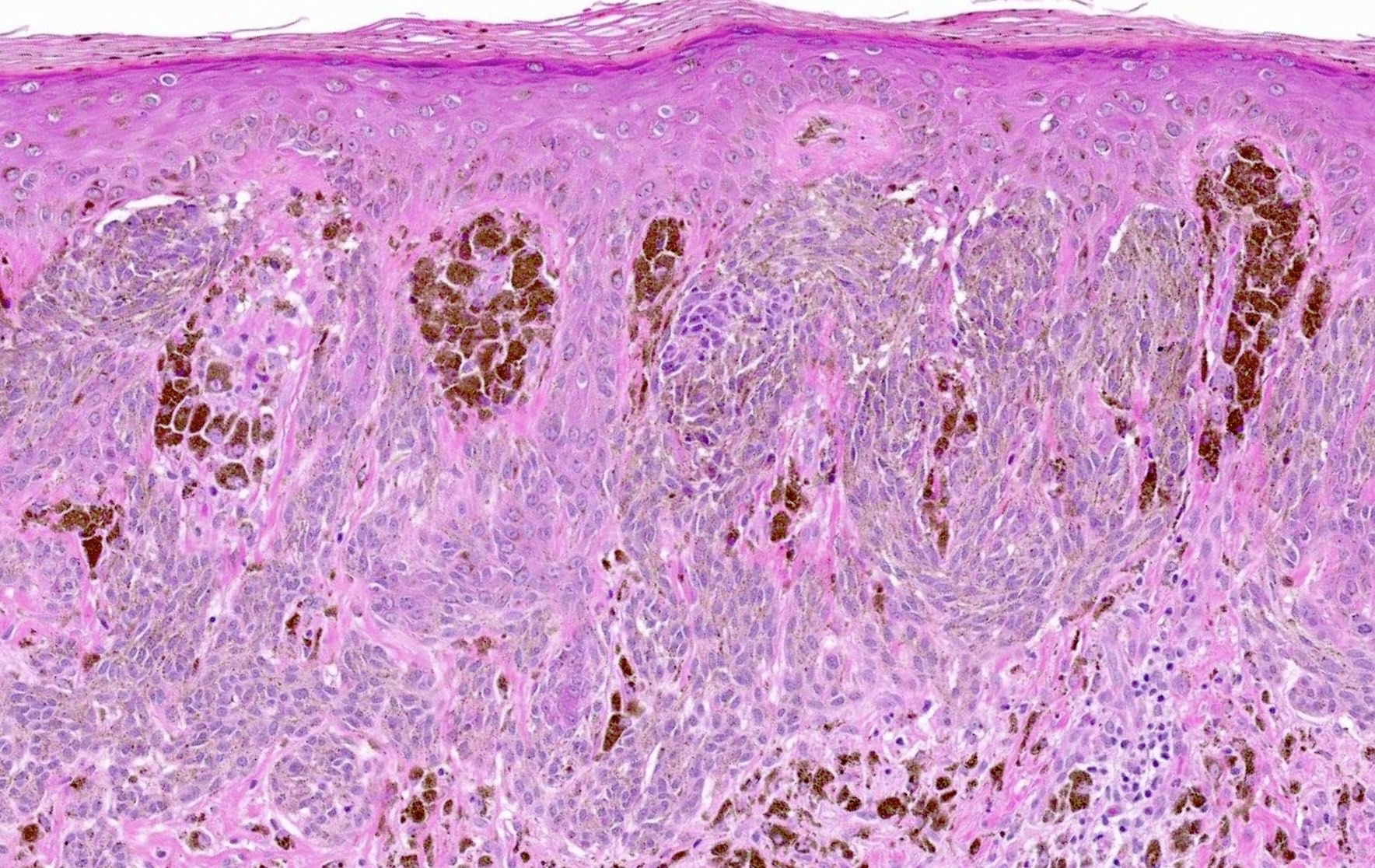 Pathology Outlines - Reed nevus