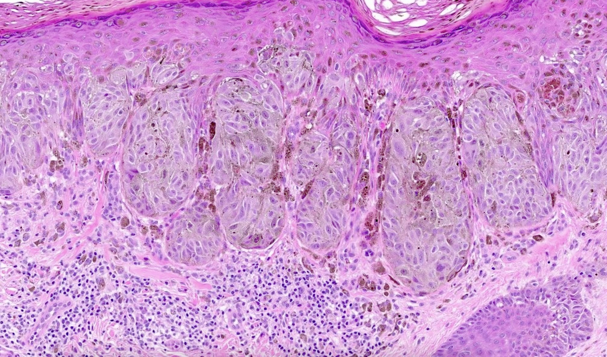 Pathology Outlines - Reed nevus