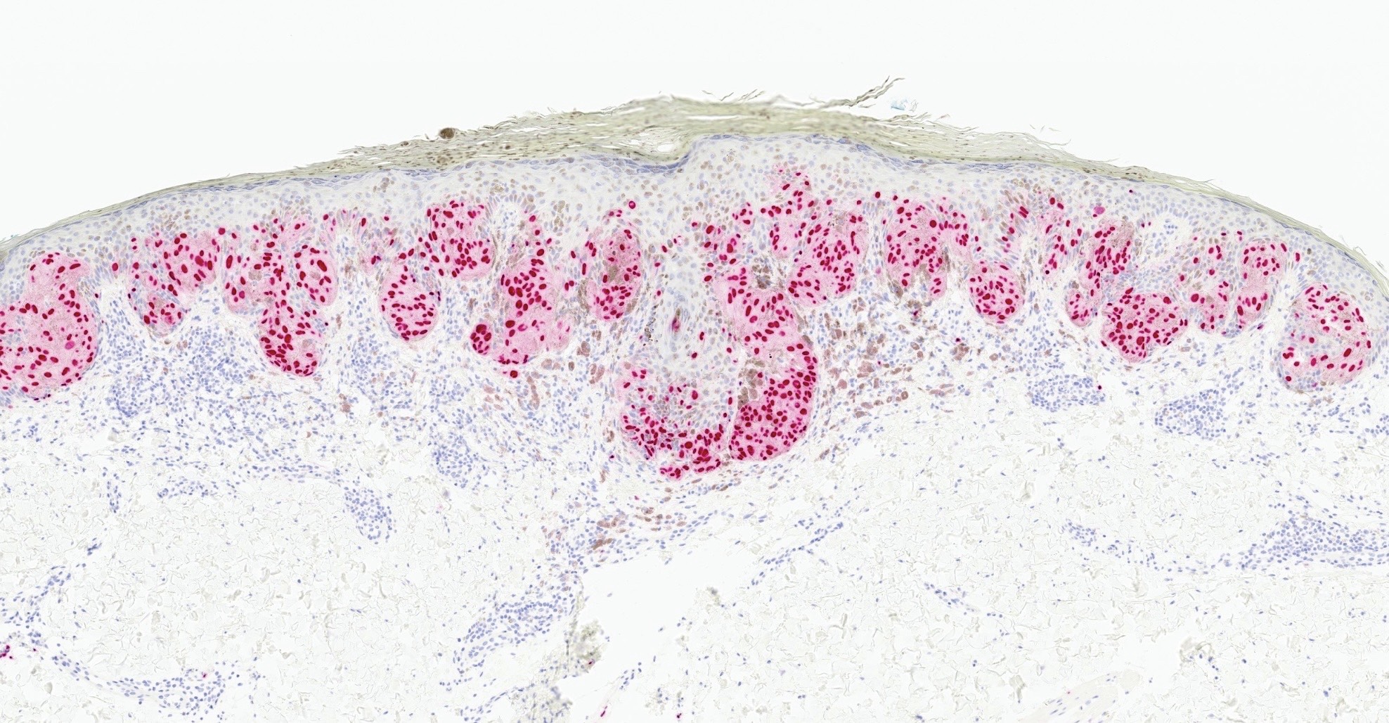 Pathology Outlines - Reed nevus