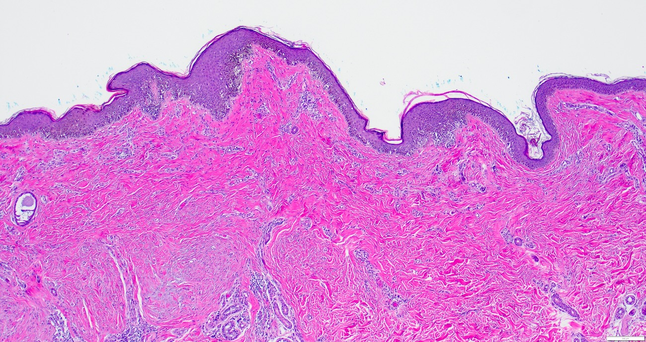 Pathology Outlines - Recurrent nevus