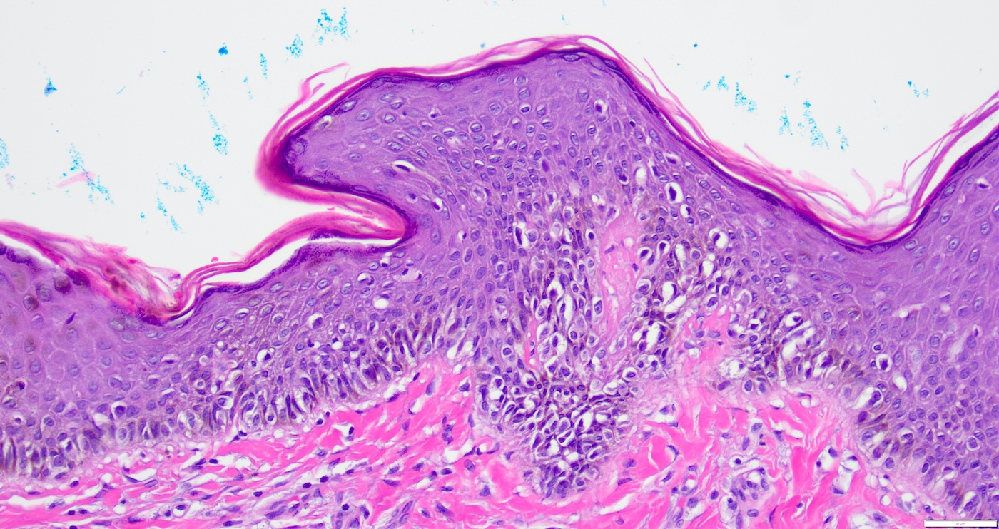 Pathology Outlines - Recurrent nevus