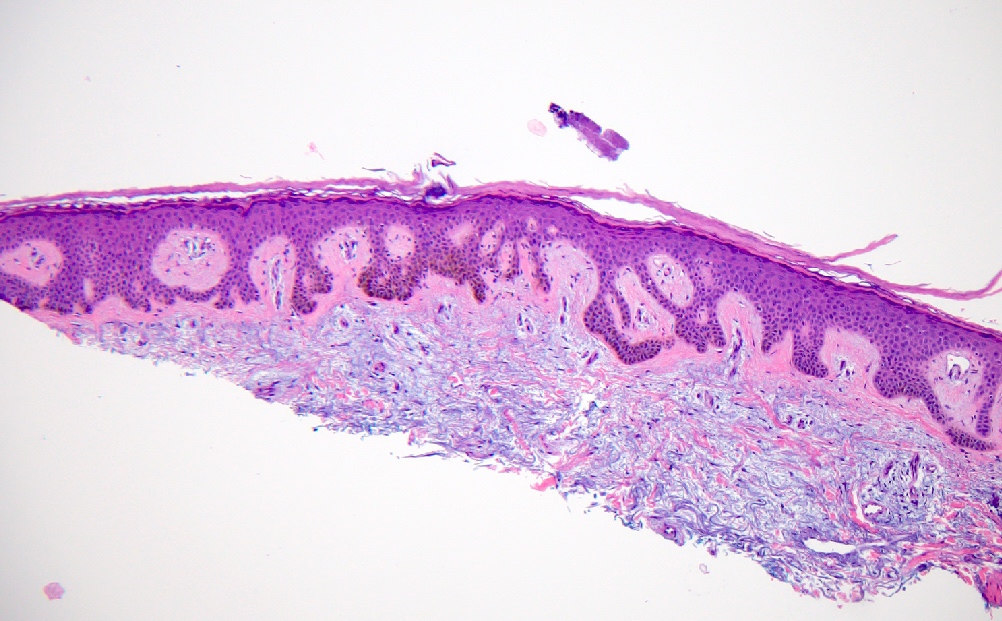 Pathology Outlines - Lentigo