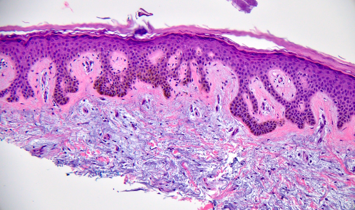 Pathology Outlines - Lentigo