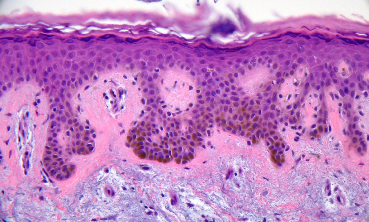 Pathology Outlines - Lentigo