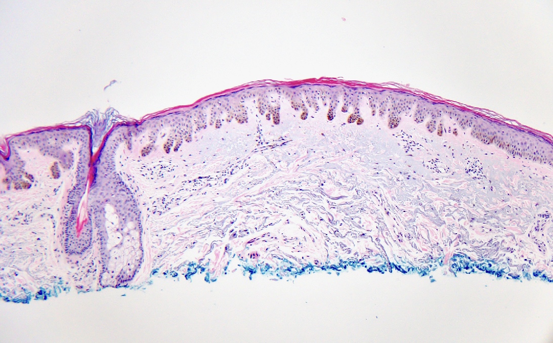 Pathology Outlines - Lentigo