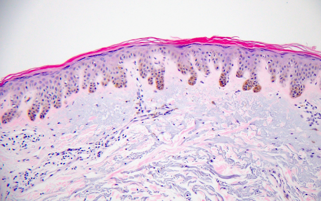 Pathology Outlines - Lentigo
