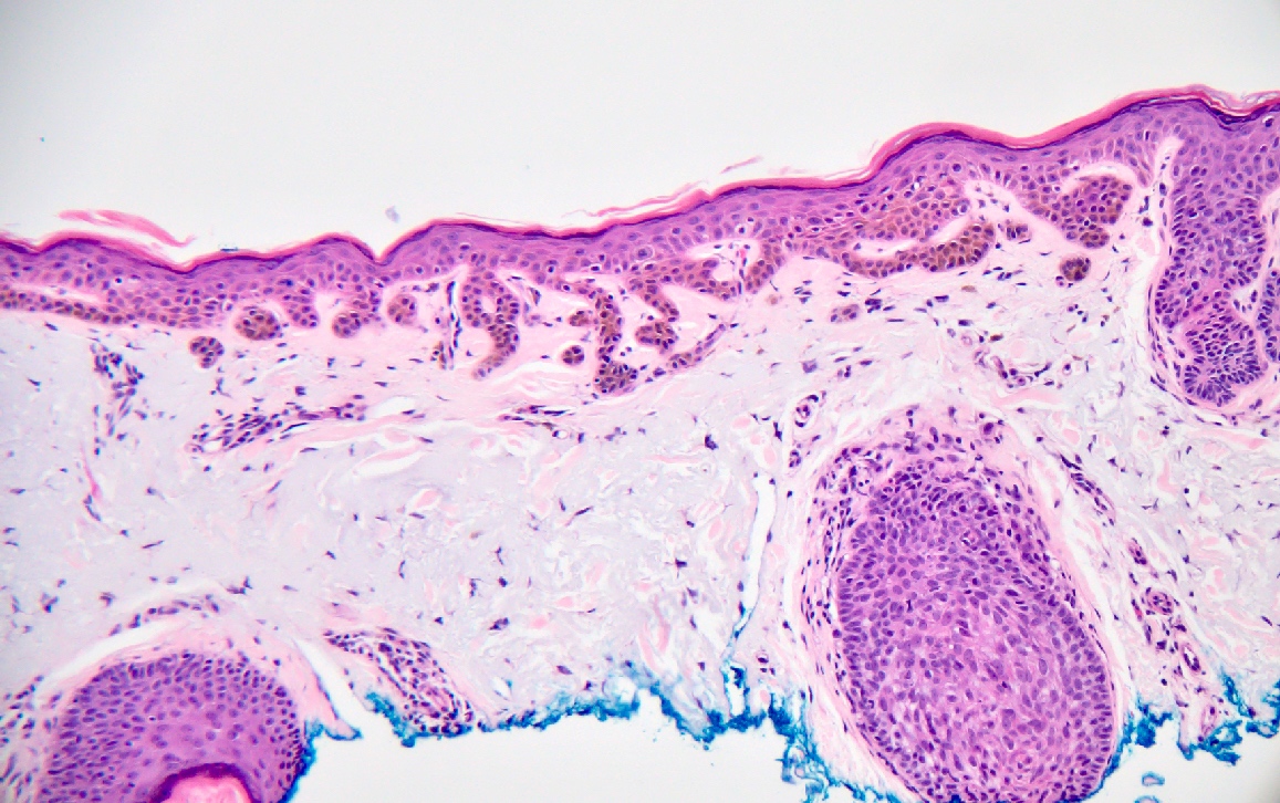 Pathology Outlines - Lentigo