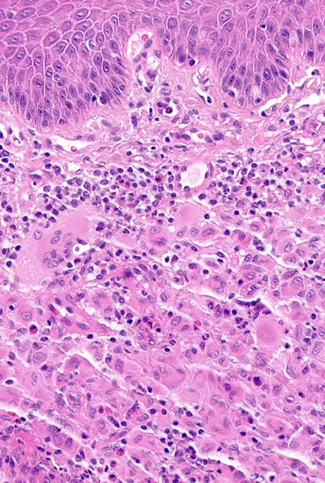 Pathology Outlines - Multicentric reticulohistiocytosis