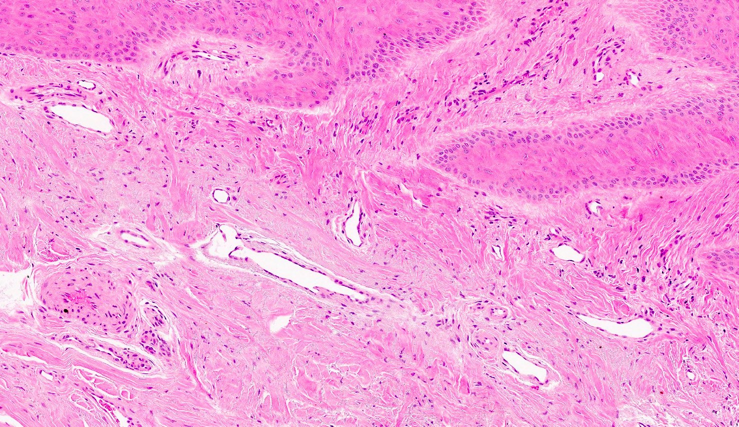 Pathology Outlines - Acquired digital fibrokeratoma
