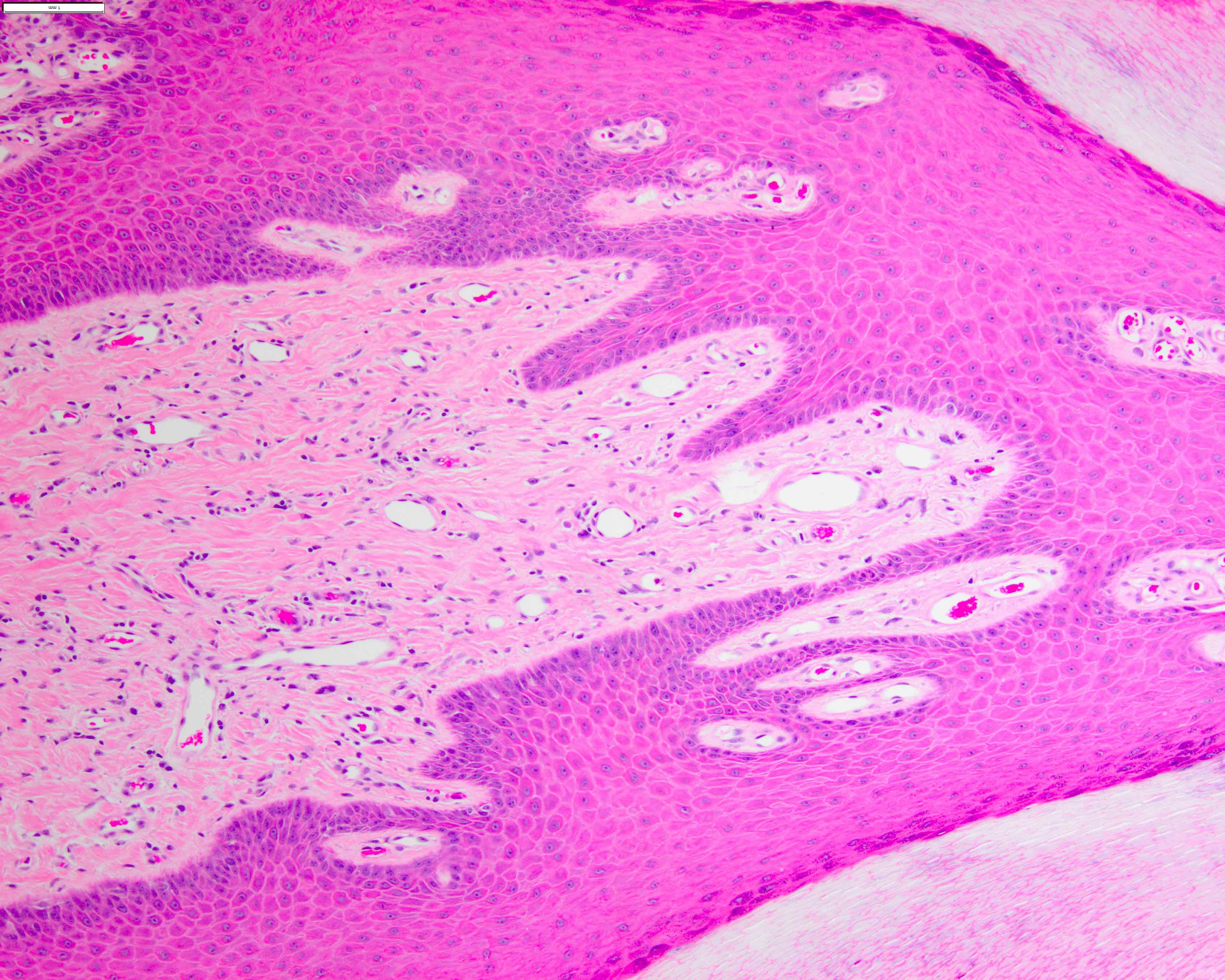 Pathology Outlines - Acquired digital fibrokeratoma
