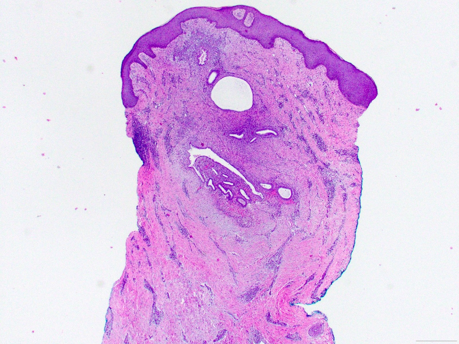 Pathology Outlines - Cutaneous endometriosis
