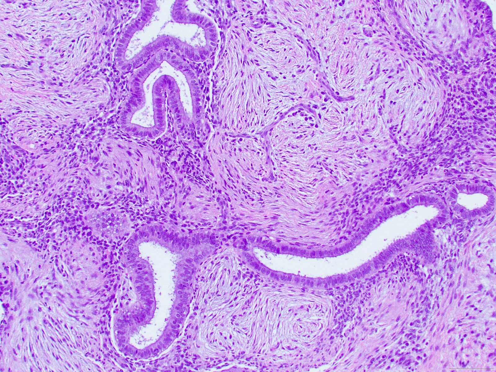 Pathology Outlines - Cutaneous endometriosis
