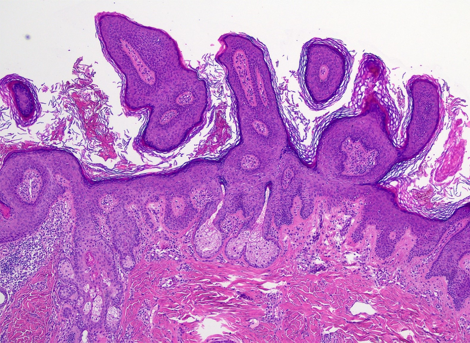 Sebaceous Hyperplasia Histology