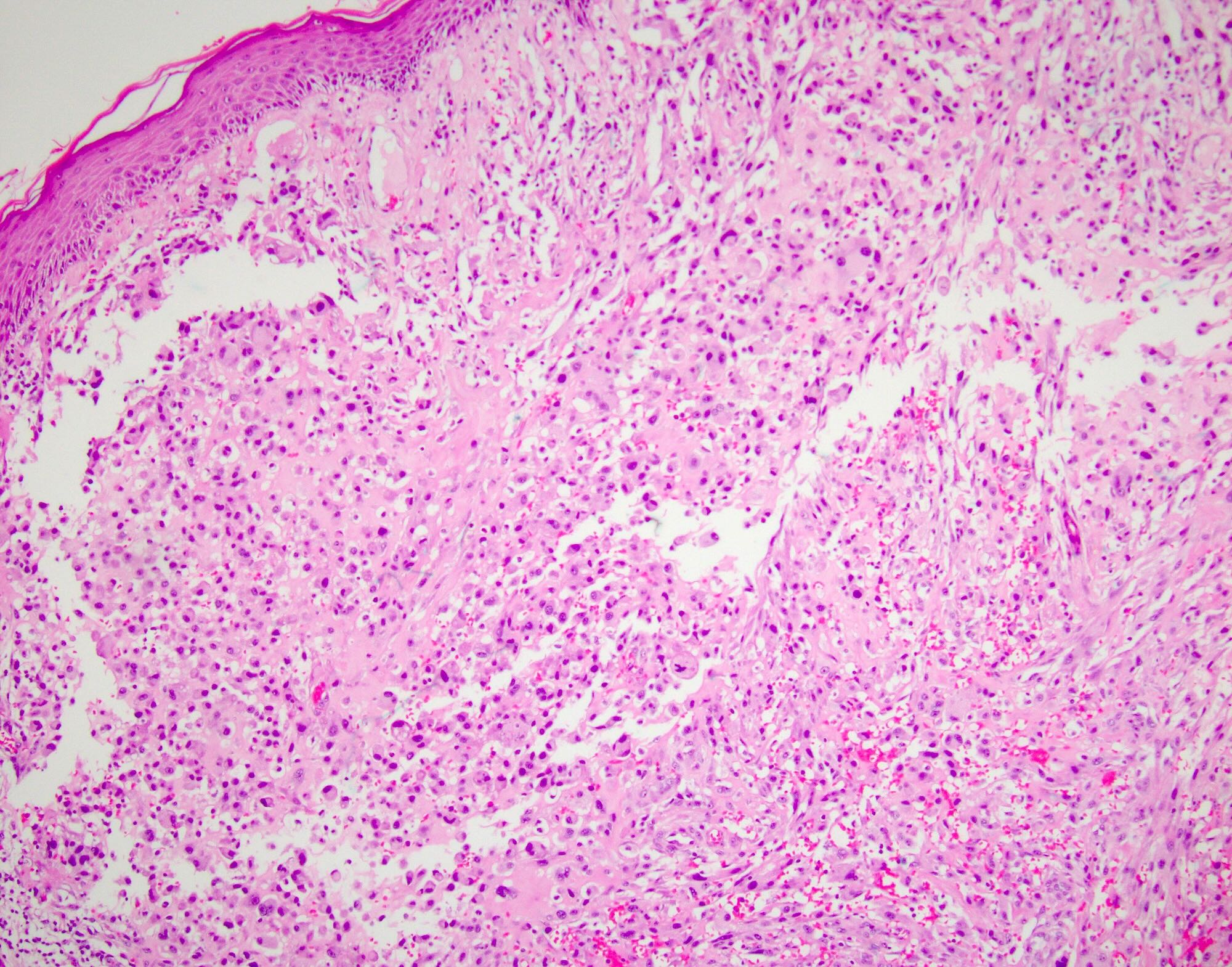 Pathology Outlines - Pleomorphic dermal sarcoma