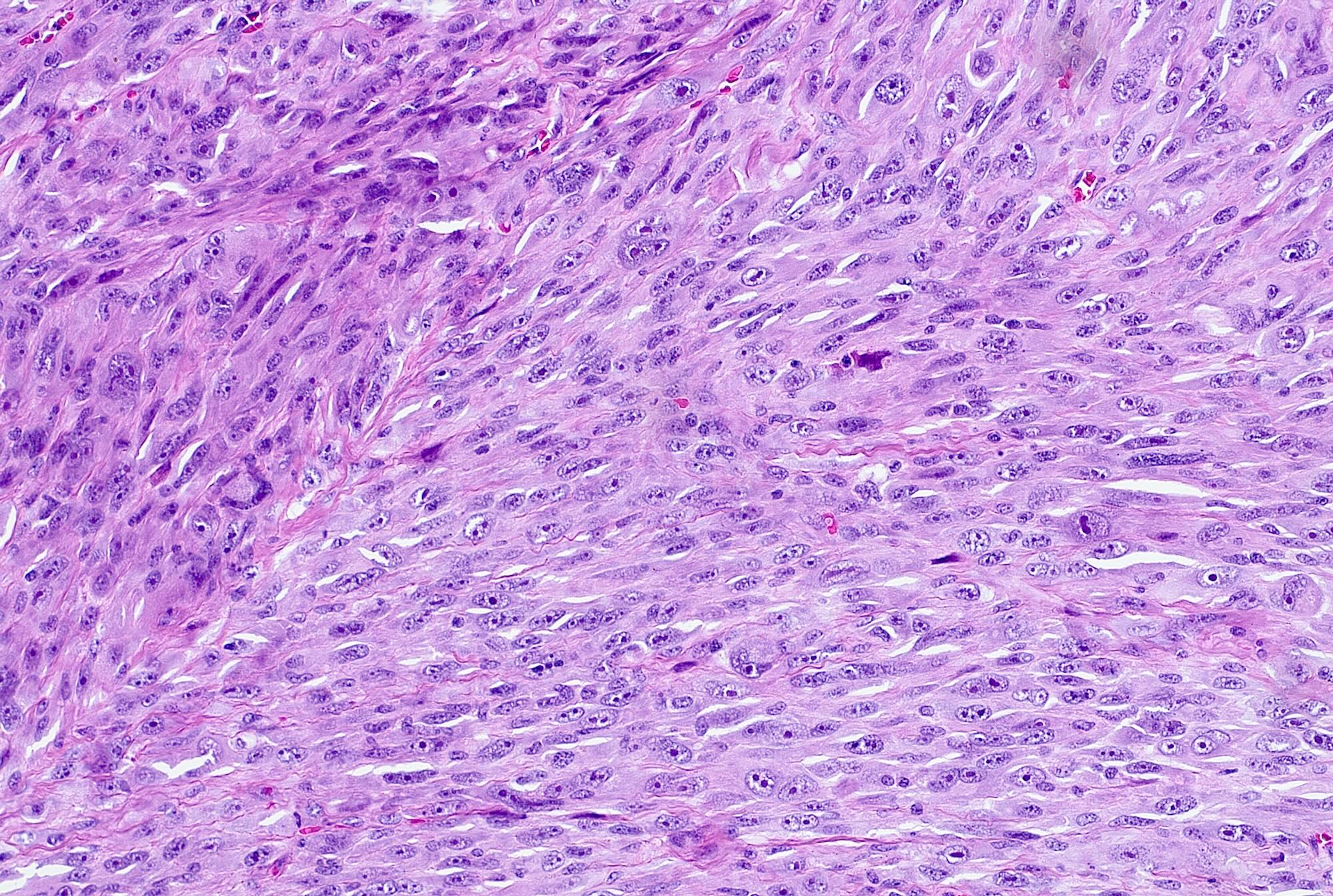 Pathology Outlines - Pleomorphic dermal sarcoma