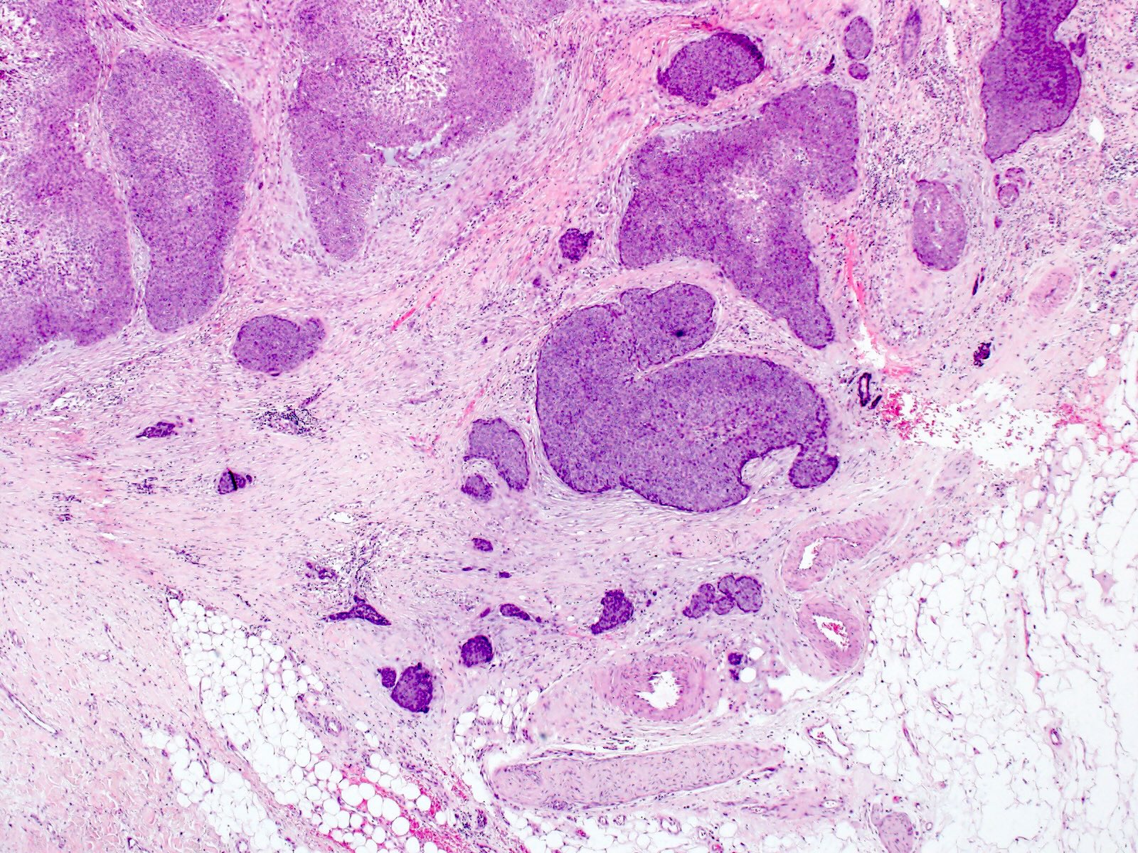 Pathology Outlines - Porocarcinoma