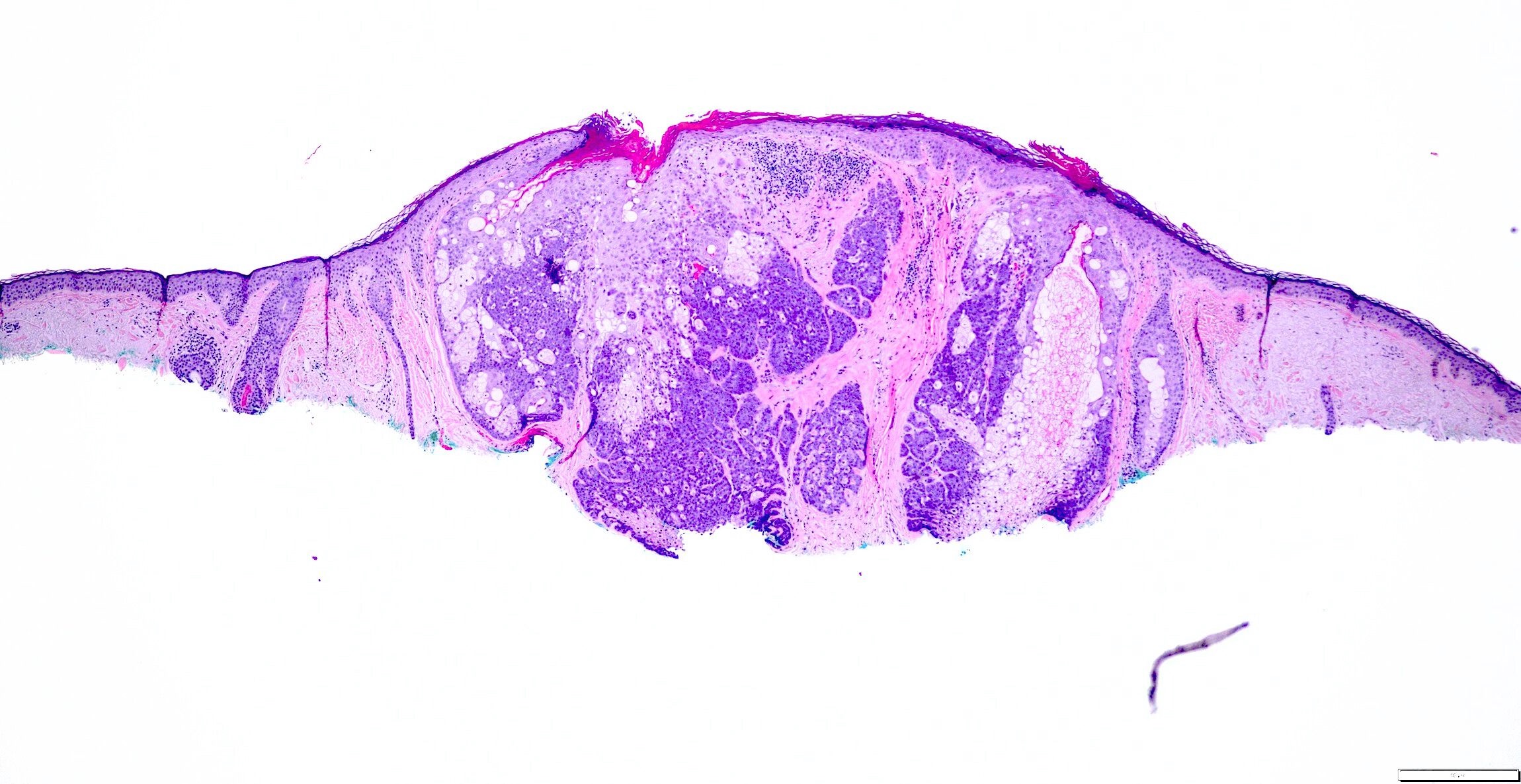 Pathology Outlines - Sebaceoma
