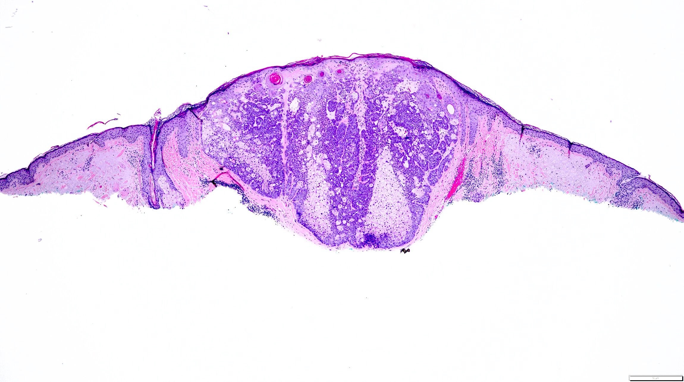 Pathology Outlines - Sebaceoma