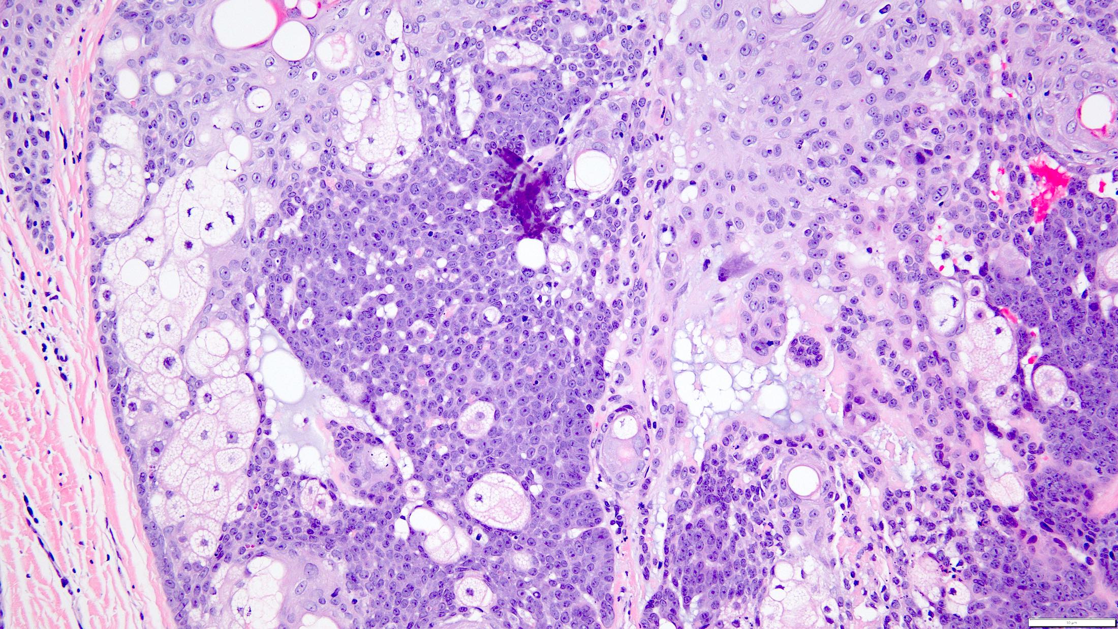 Pathology Outlines - Sebaceoma