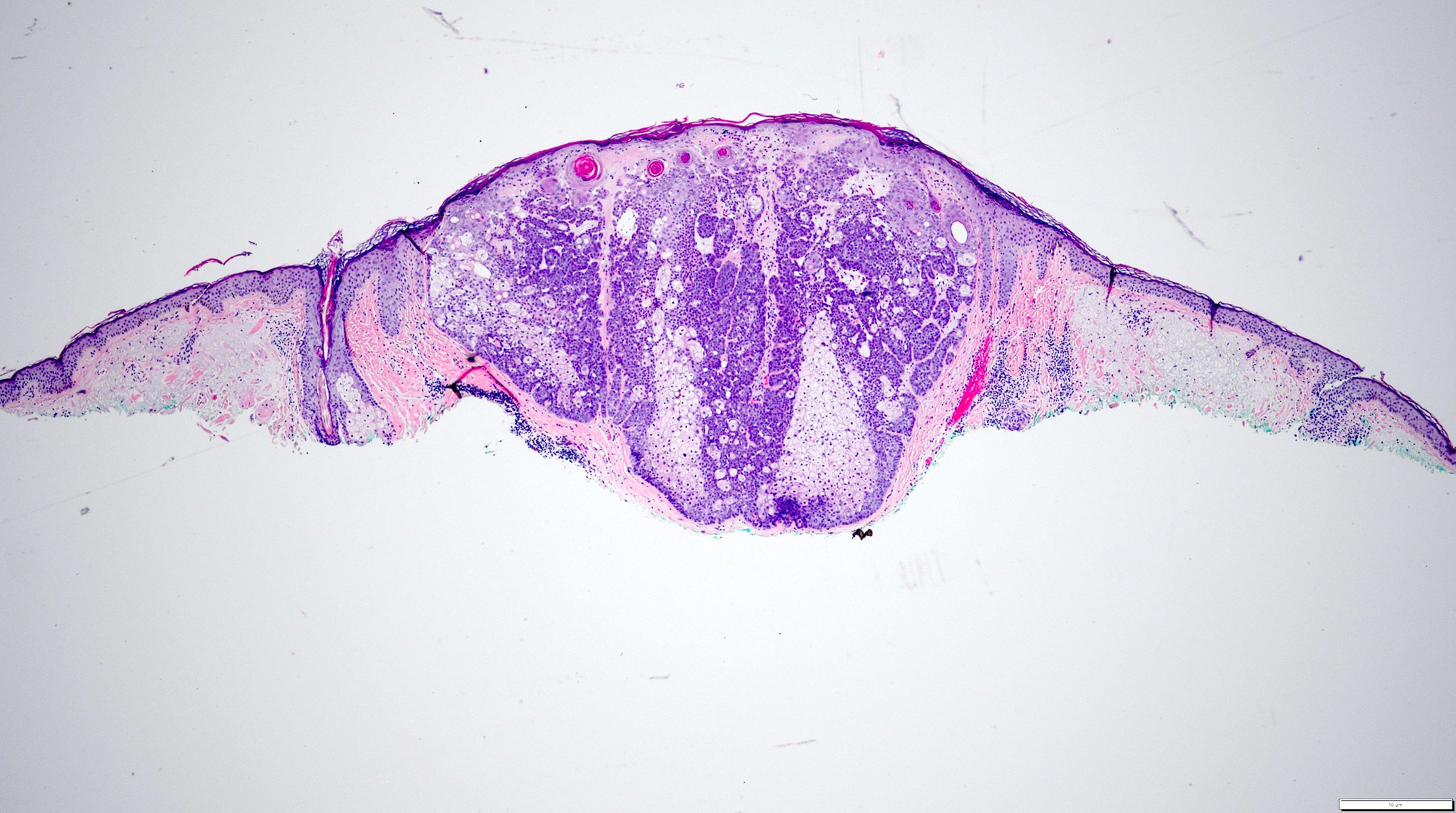 Pathology Outlines - Sebaceoma