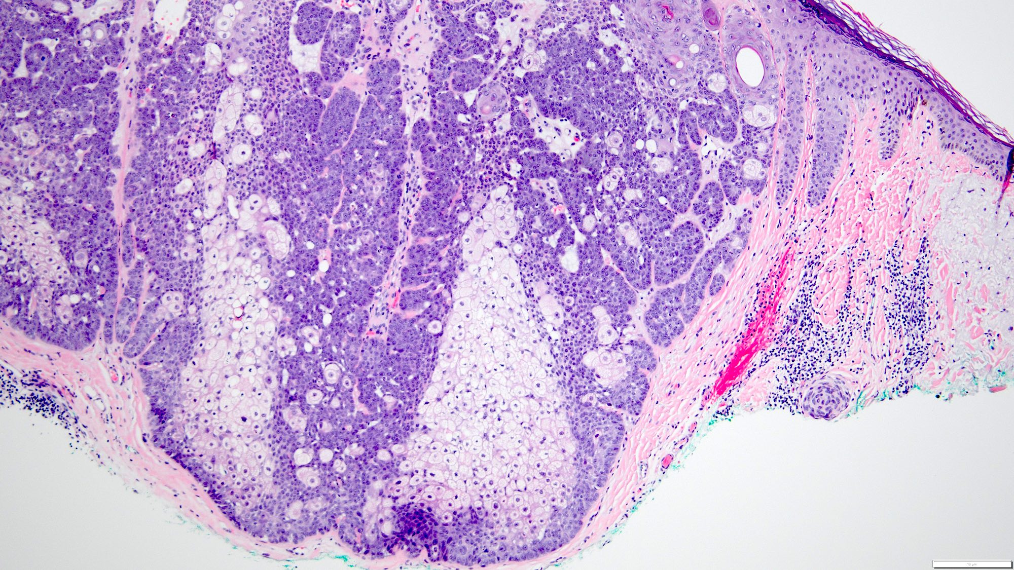 Pathology Outlines - Sebaceoma