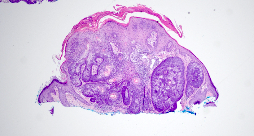 Pathology Outlines - Sebaceoma