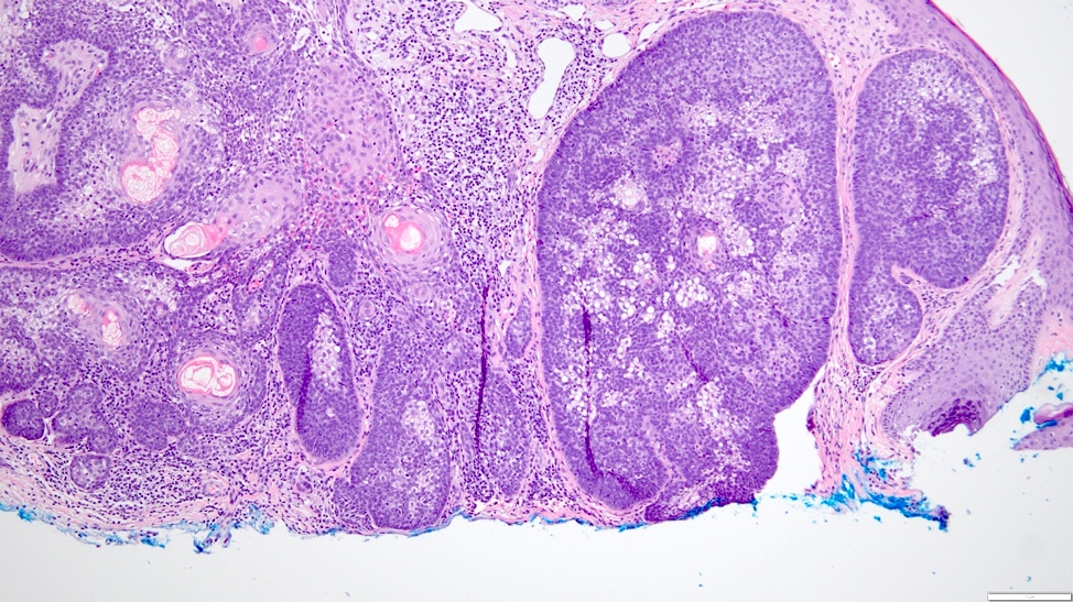 Pathology Outlines - Sebaceoma