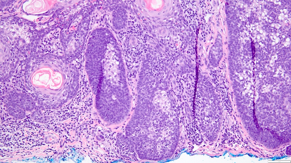 Pathology Outlines - Sebaceoma