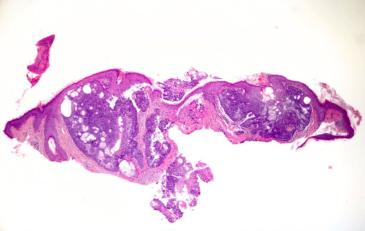 Pathology Outlines - Sebaceoma