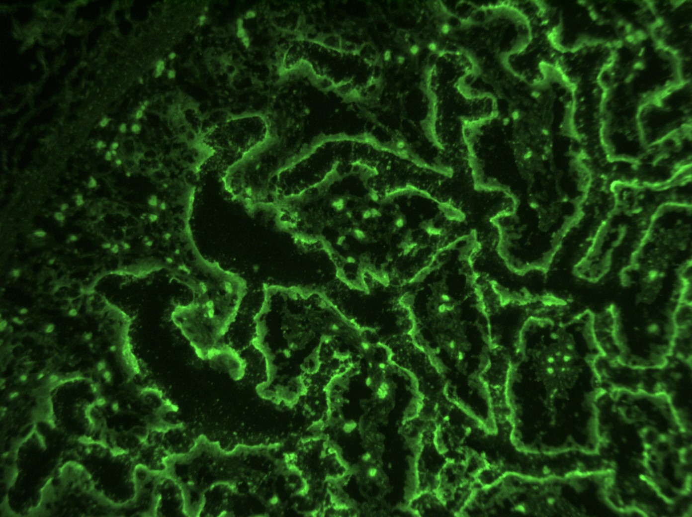 Pathology Outlines - Autoimmune enteropathy