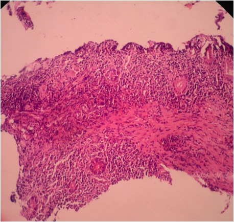 Pathology Outlines - Ileal pouch / pouchitis