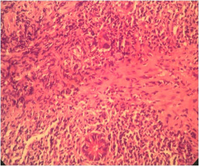 Pathology Outlines - Ileal pouch / pouchitis