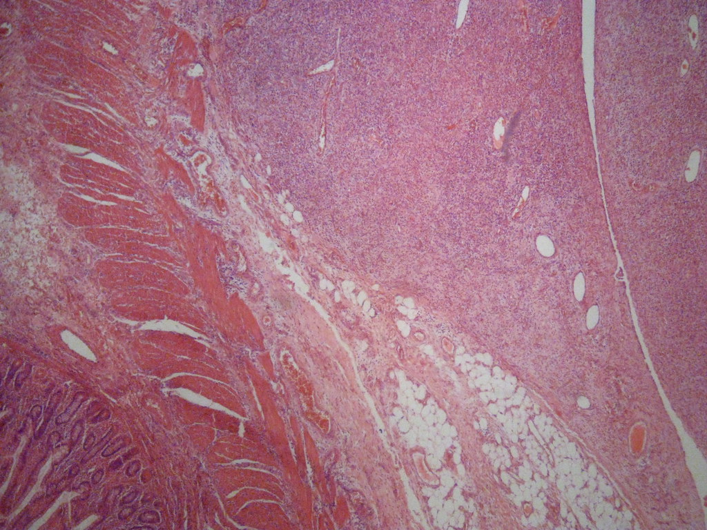 Pathology Outlines - Inflammatory fibroid polyp