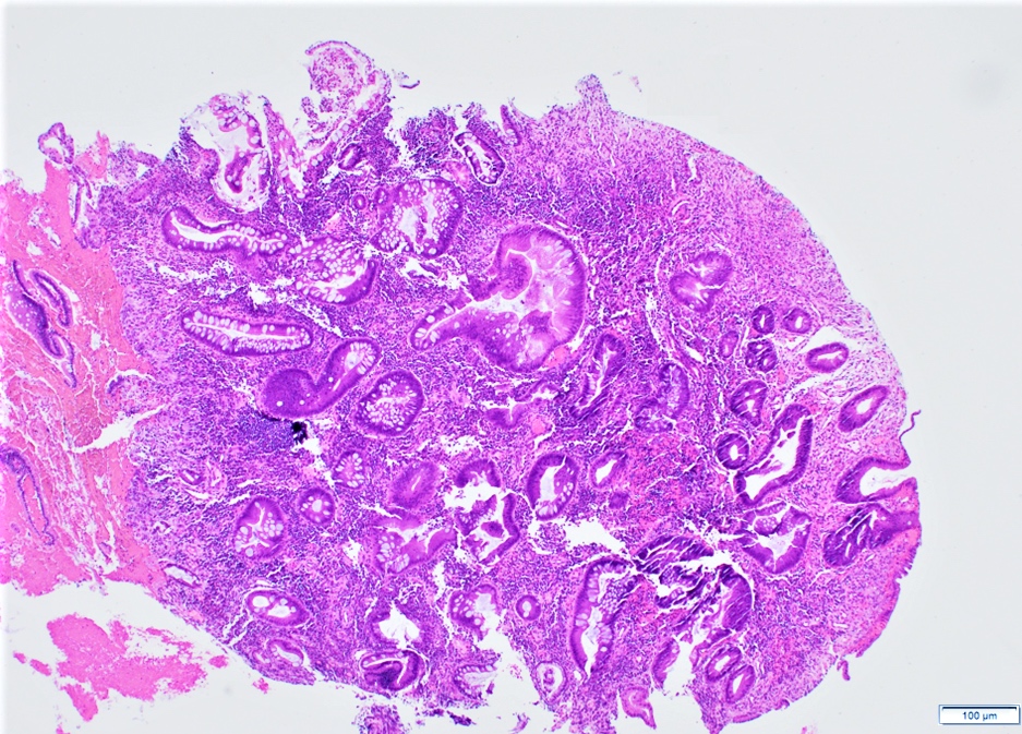 Pathology Outlines Juvenile Polyposis