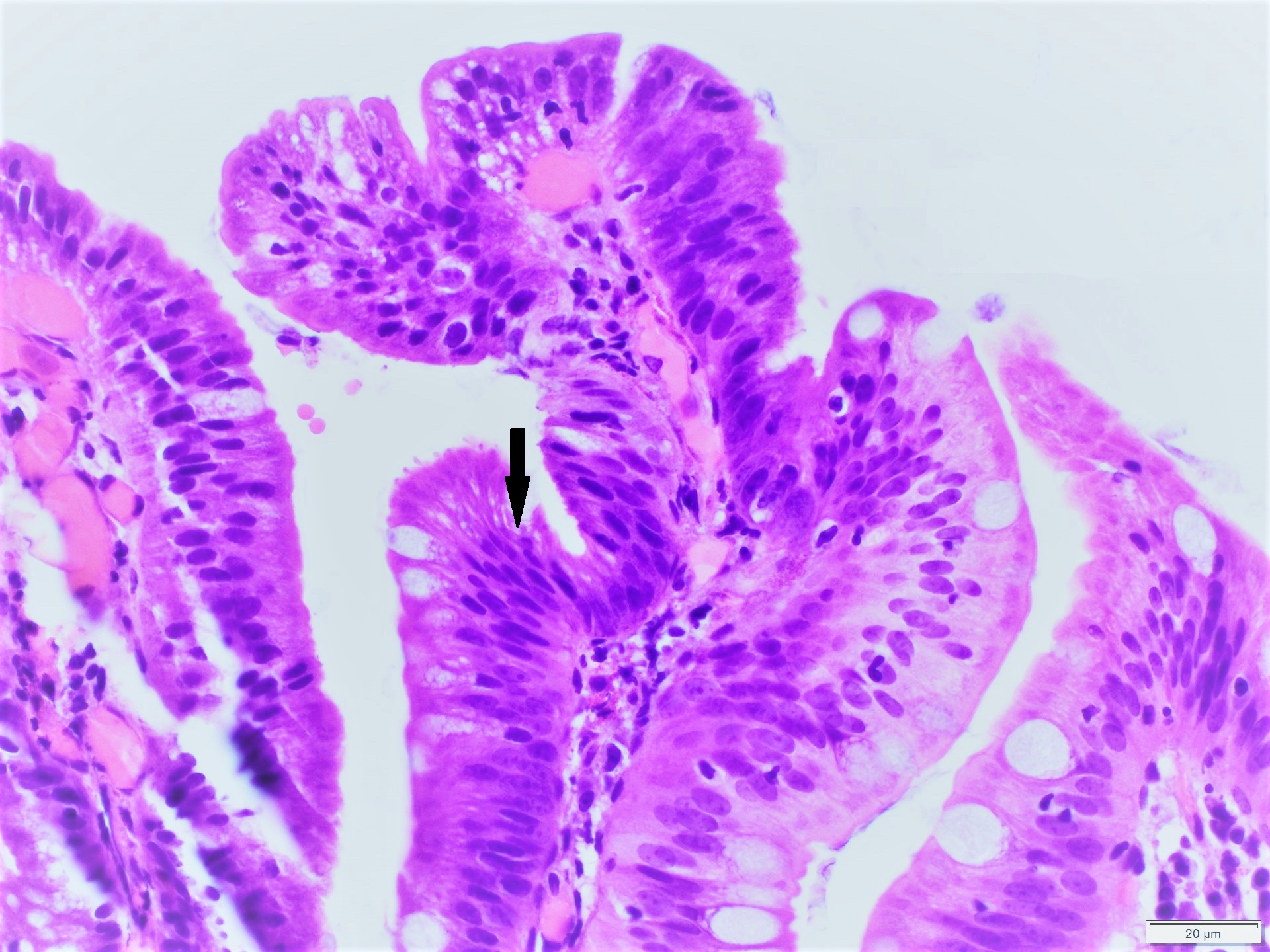 Pathology Outlines - Juvenile polyposis