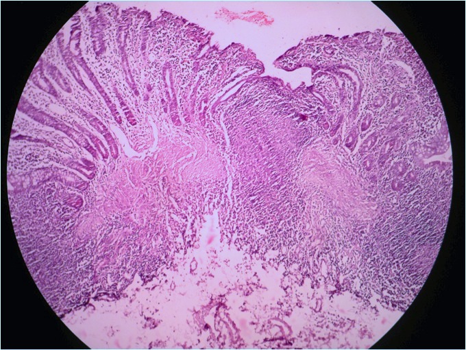 Pathology Outlines - Tuberculosis