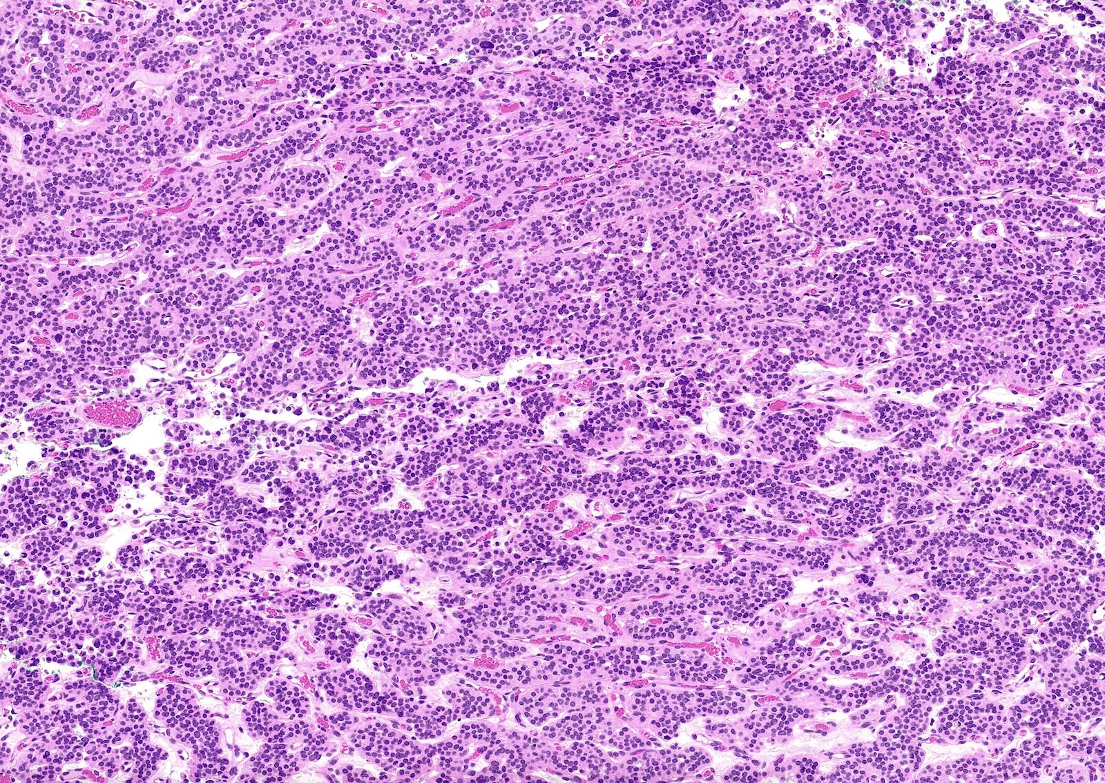 Pathology Outlines - GLI1 altered soft tissue tumors